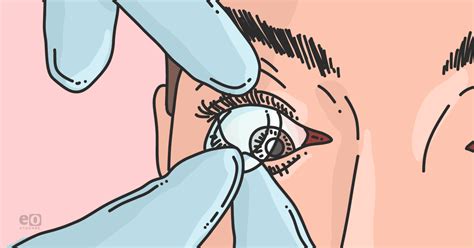 Using Cryopreserved Amniotic Membranes For Pre Surgical Ocular Surface Optimization