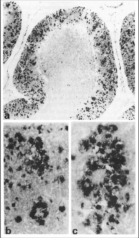 Figure 1 From Cerebrospinal Fluid Levels Of Amyloid β‐protein Precursor