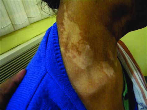 Chemical Vitiligo At The Neck From A Blue Sweater Azo Dye Download
