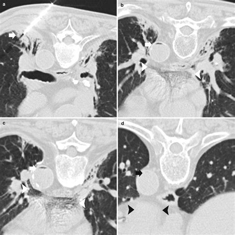 Percutaneous Transthoracic Lung Biopsy Radiology Key