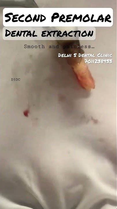 Dental Extraction Maxillary Second Premolar Delhi 5 Dental Clinic