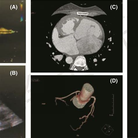 A B Ultrasonic Cardiogram C D Computed Tomography Cardiac Download Scientific Diagram