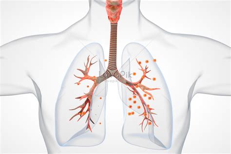 기관지염 이미지 사진 및 Png 일러스트 무료 다운로드 Lovepik