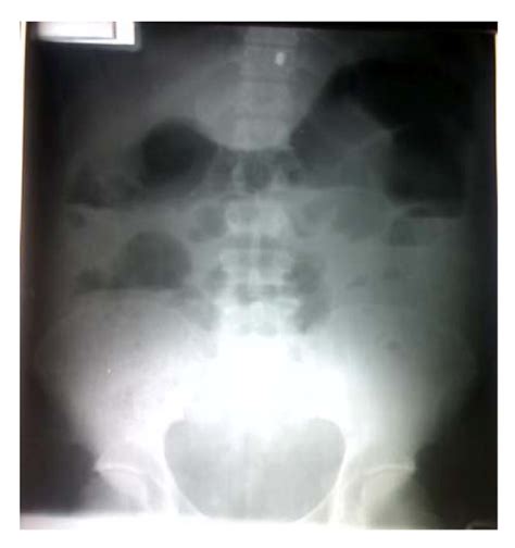 Erect Film Shows Multiple Air Fluid Levels Download Scientific Diagram