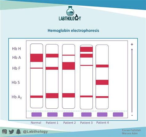 Hemoglobin Electrophoresis Medizzy