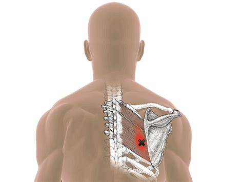 Rhomboids Trigger Points