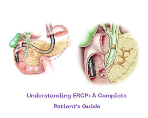 Understanding Ercp A Complete Patients Guide To Diagnosis And Treatment