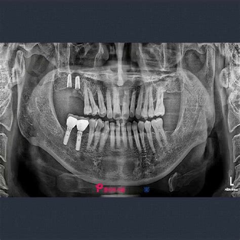 실패한 임플란트 재수술 올바른 병원 선택이 중요합니다 죽전치과 네이버 블로그