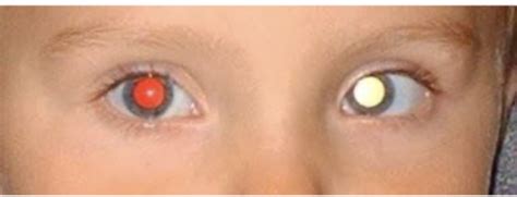 7 Pediatric Eye Exam Procedures Flashcards Quizlet