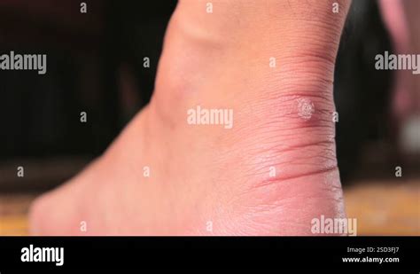 Putting Bandage Patch On The Leg Man Putting Medical Patch On The