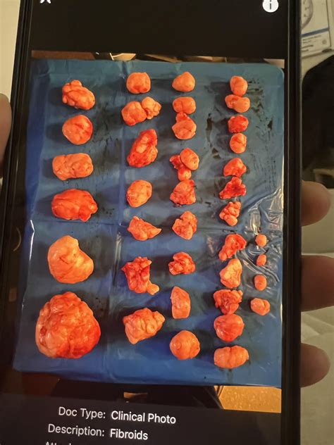 I Had 34 Fibroids Removed And Im Doing Great Rfibroids