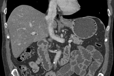 Adenocarcinoma Of The Gastroesophageal Ge Junction Stomach