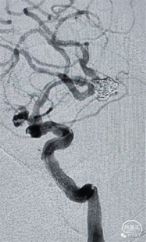 中枢介入第347期：大脑中动脉瘤分叉部动脉瘤出血 双微导管长圈技术裸栓 脑医汇 神外资讯 神介资讯