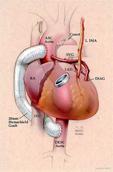 Aortic Bypass