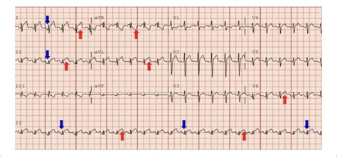Electrocardiogram On Initial Presentation Demonstrating Diffuse