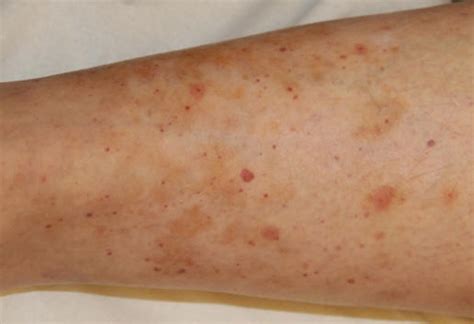 A Case Of Cutaneous Vasculitis With Underlying Hepatitis C And