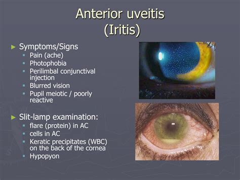 Iritis Vs Conjunctivitis