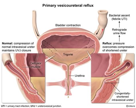 Posterior Urethral Valves Nephrology Uworld Medical Library