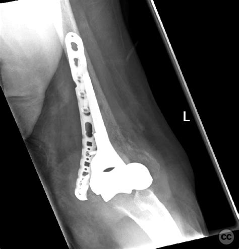 Fracture Hemiarthroplasty Distal Humerus