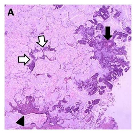 A Mucinous Adenocarcinoma With Lepidic Growth Pattern White Arrows