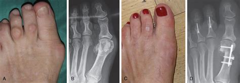 Lesser Toe Deformities Clinical Tree