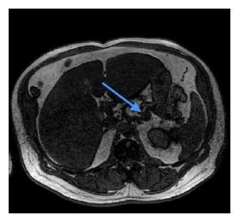 Mri Of The Adrenals Within The Lateral Limb Of The Left Adrenal Gland Download Scientific