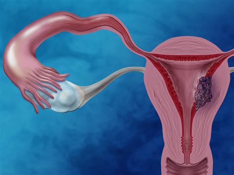Treating Endometrial Cancer Without Radiation Nci
