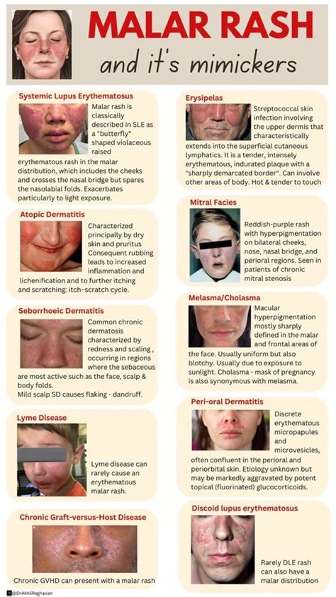 Causes Of Butterfly Rash Lupus Rash Under The Breasts Pictures