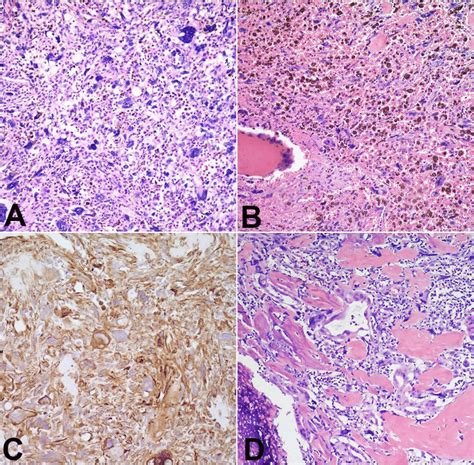 Photomicrography Of The Pancreatic Mass Showing In A Pleomorphic Giant