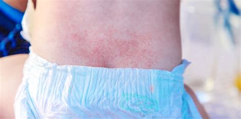 Diaper Rash Treatment Types Of Diaper Rash