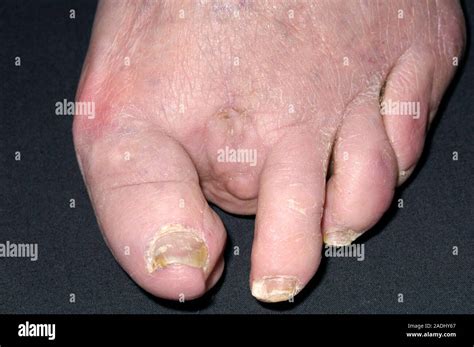 Amputation For An Ulcerated Hammer Toe Amputated Second Toe Of A 79