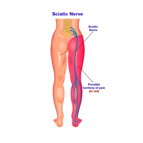 Inflammation Of The Sciatic Nerve Understanding Its Origin And How To Prevent It Chiro Du