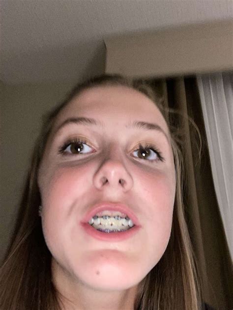 Perfect Teeth Cute Poses For Pictures Braces Pretty Face Photo Wall