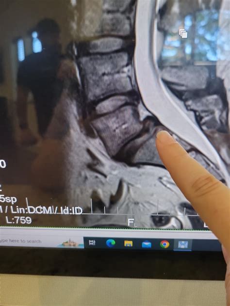 Sex And Spinal Fusion R Spinalfusion