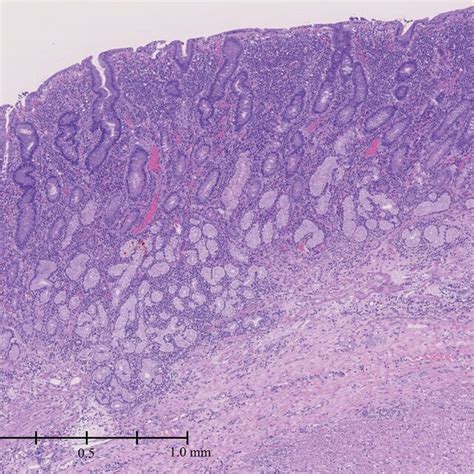 A Upper Gastrointestinal Endoscopic Image Gastric Ulcers Are Seen On