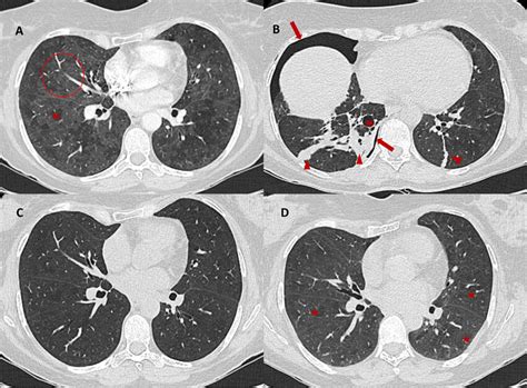 A Baseline High Resolution Ct Scan Showing A Diffuse Heterogeneous Download Scientific