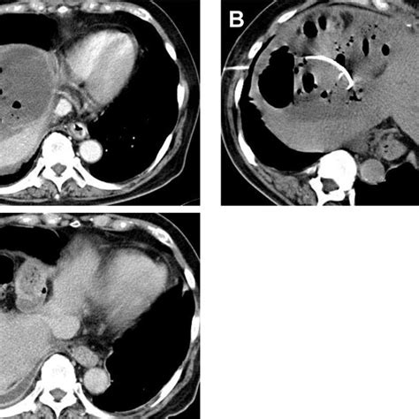 Pdf Subphrenic Abscess Due To Clostridium Perfringens After Hepatic