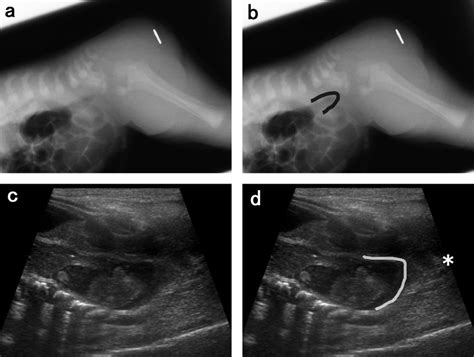 What Is A Cross Table X Ray At Harvey Field Blog
