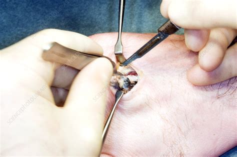 Excision Biopsy Stock Image C Science Photo Library