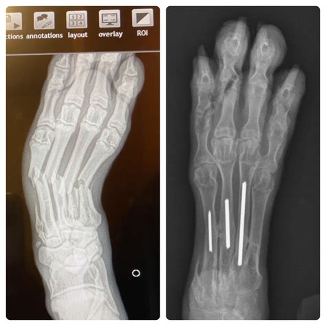 My Pups Metacarpal Fracture Scrolller