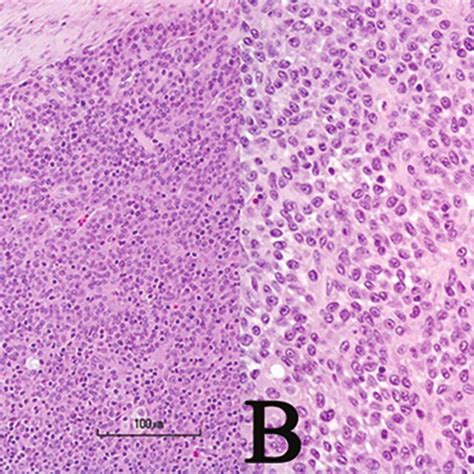 Photomicrographs Of The Cervical Mass A The Neoplasm Is Encapsulated