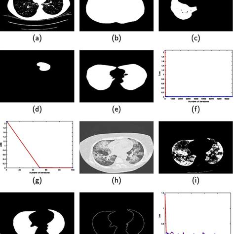 Cellular Nsip Pattern The Multiplanar Axial A And Coronal B