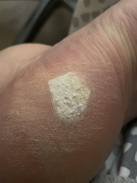 Plantar Wart Journey Rwarts
