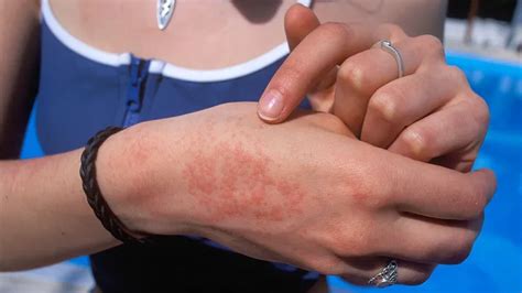 Rashes On Hands