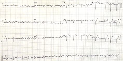 Electrocardiograma De Reposo En El Que Se Observa Flutter Auricular Download Scientific Diagram
