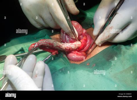 Inflammation Appendix Usually Affects Younger People Chief Symptom