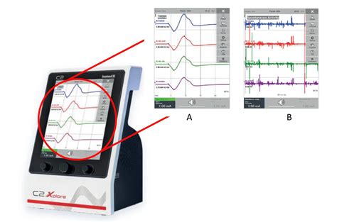 Facial Nerve Monitoring In Vestibular Schwannoma Surgery Louis Hofmeyr