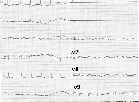Posterior Ekg Aciltı