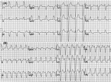 A Sinus Rhythm Left Bundle Branch Block B Svt The Qrs Morphology