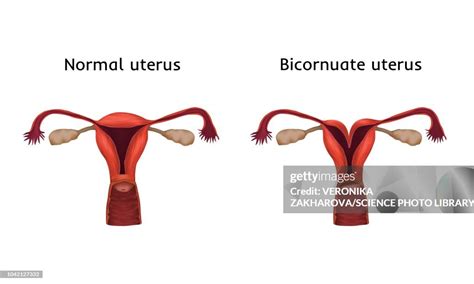 Bicornuate Uterus Bicornuate Uterus By Science Photo Library